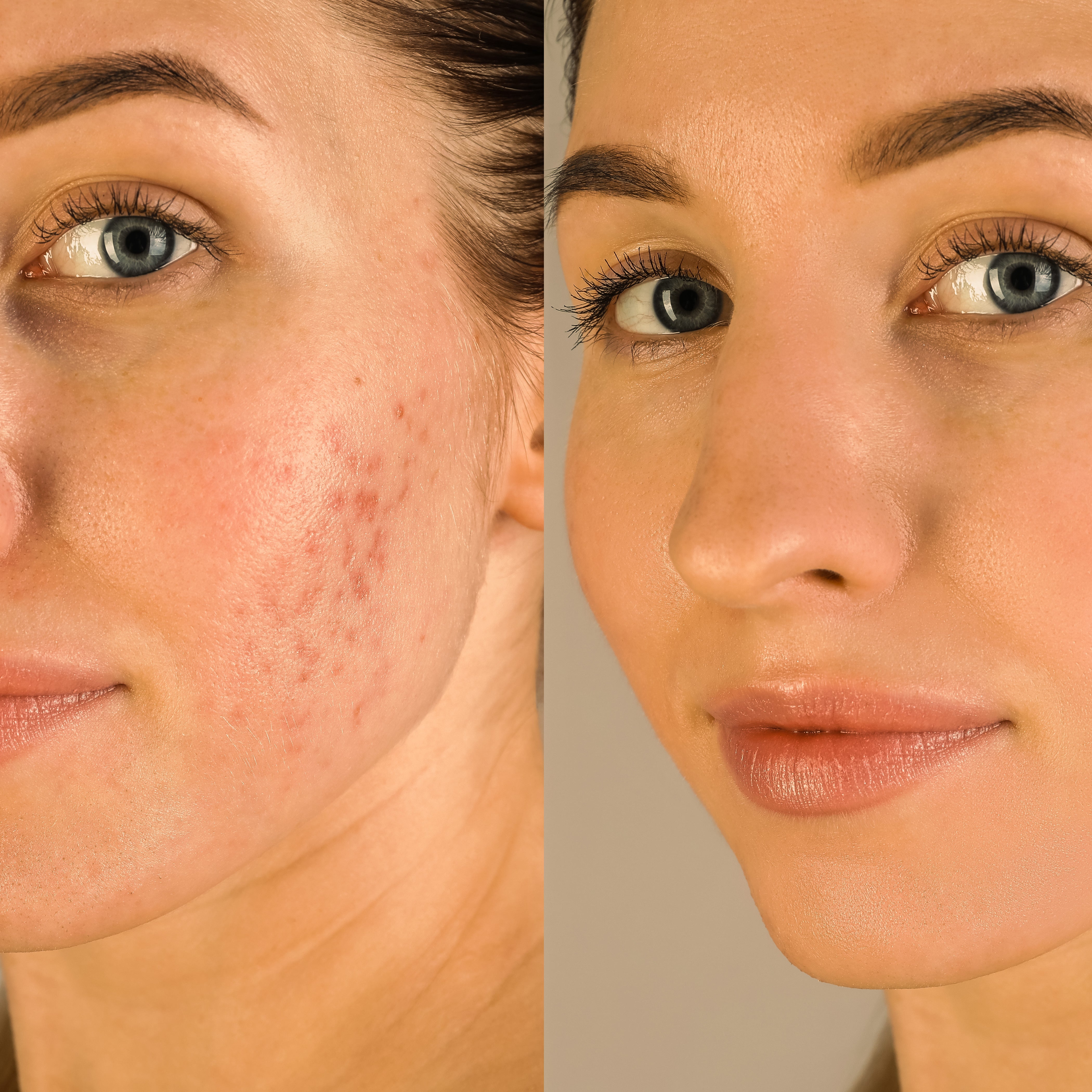 Acne Collection - Reduce Redness and Skin Inflammation – Aureterra